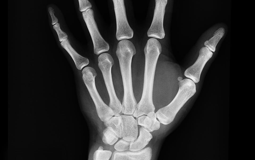 What is kVp in Radiology? Simply Explained - Rad Insights