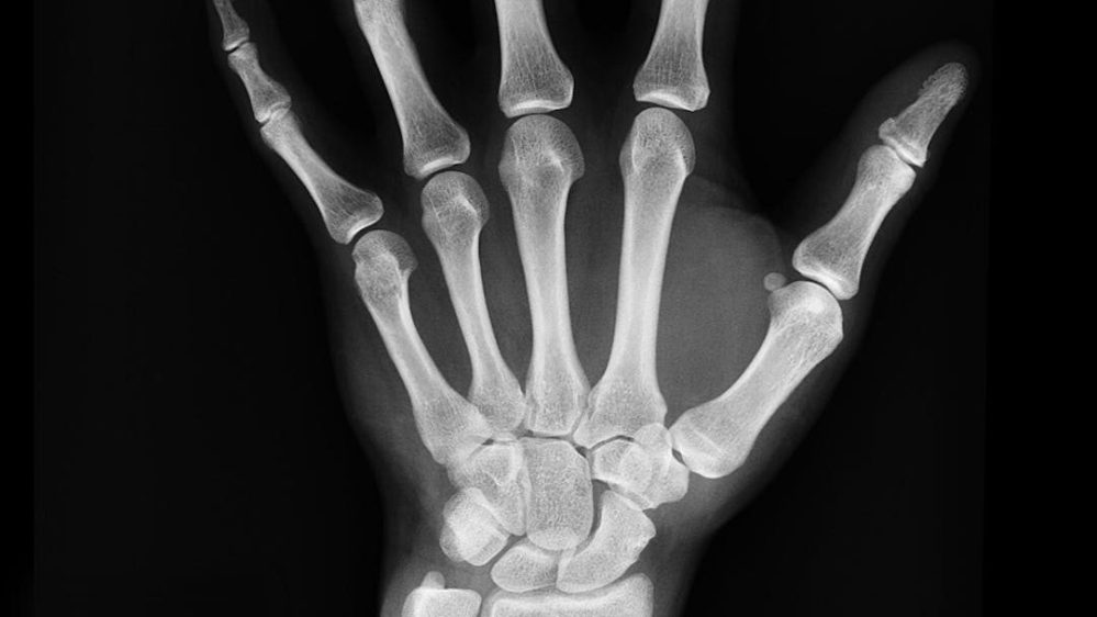 What Does Attenuation Mean in Radiology? - Rad Insights